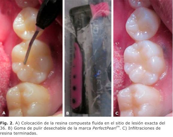 Infiltración de resina como tratamiento mínimamente invasivo de ...