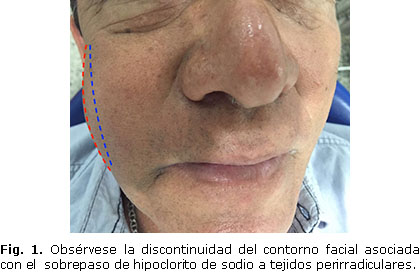 Accidente con hipoclorito de sodio durante la terapia endodóntica ...