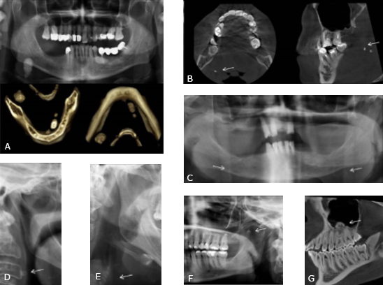 Calcificaciones de tejidos blandos: consideraciones diagnósticas ...