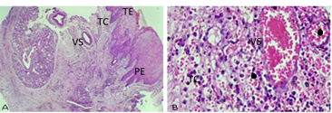 Mucositis periimplantaria asociada a ortodoncia correctiva | Lozada ...