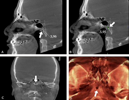 Fossa navicularis magna: detección por tomografía computarizada de haz ...