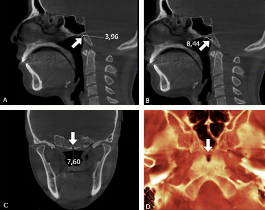 Fossa navicularis magna: detección por tomografía computarizada de haz ...