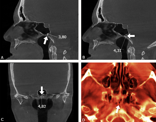 Fossa navicularis magna: detección por tomografía computarizada de haz ...